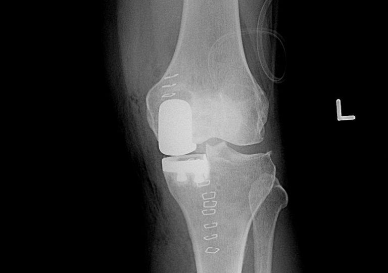 Total Knee Replacement In SG | Liberty Orthopaedic Clinic